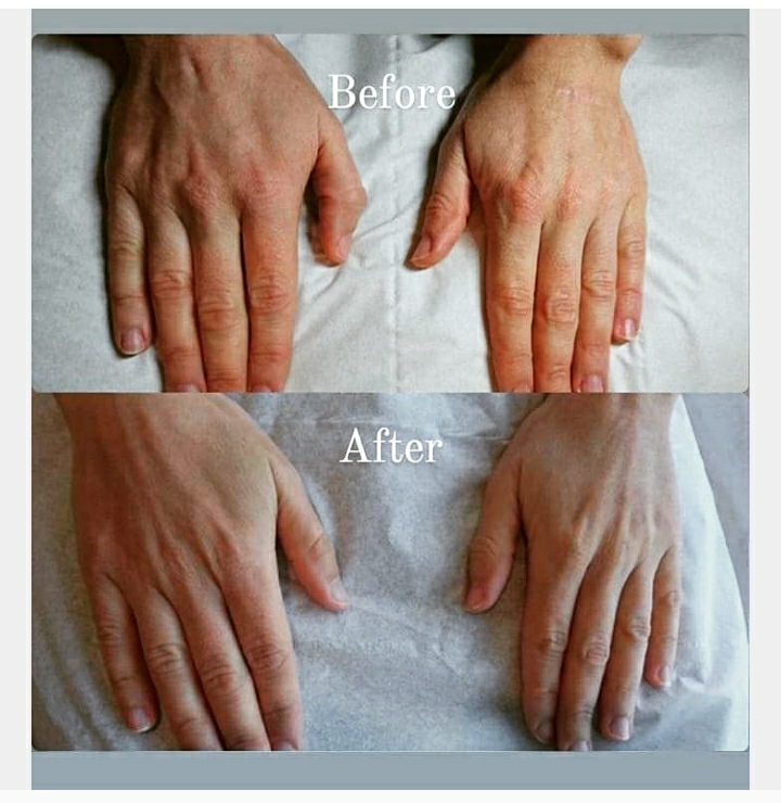 Microneedling - The Country Salon & Aesthetics